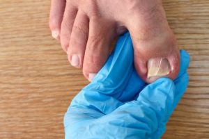 Paronychia vs. Ingrown Toenails | Elizabeth E. Auger, DPM