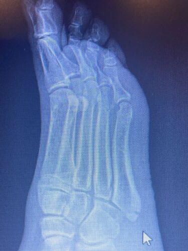 I Sprained My Ankle: Is It Worth Getting an X-Ray? | Elizabeth E. Auger ...