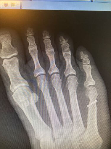 Tailor’s Bunion: Causes and Treatment Options | Elizabeth E. Auger, DPM